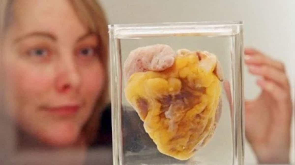 Woman sees own heart in a museum, 16 years after her life-saving ...