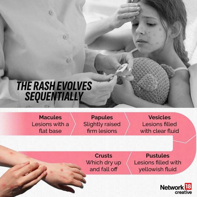In Graphics | A simple guide to understanding mpox – Firstpost