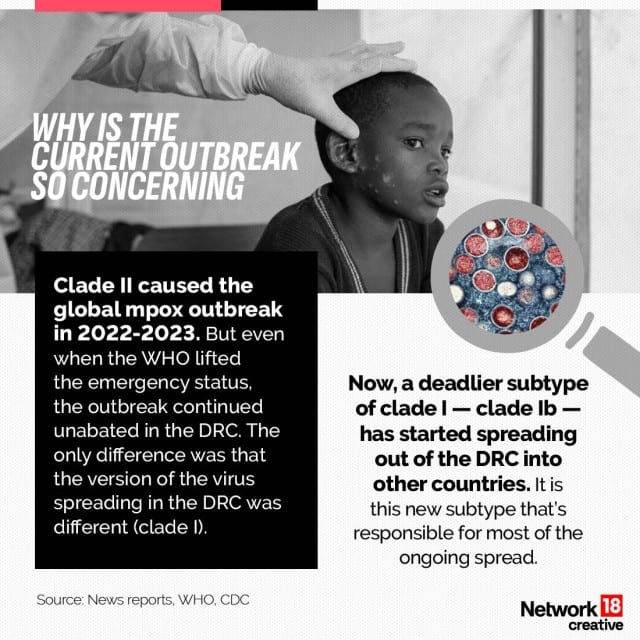 First mpox case in India: How does it spread, what are the symptoms to ...