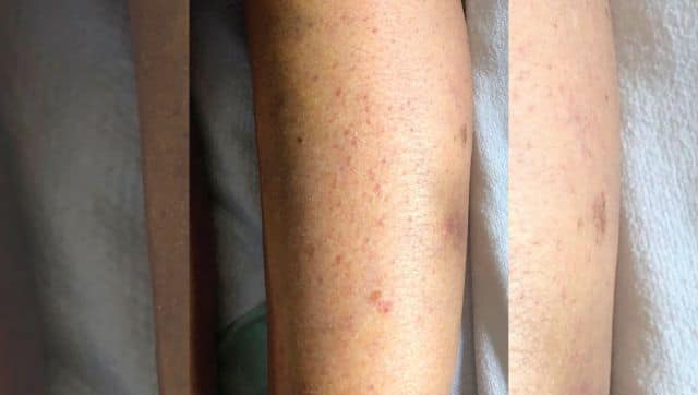 What's the 15th-century disease 'scurvy' making a comeback? – Firstpost