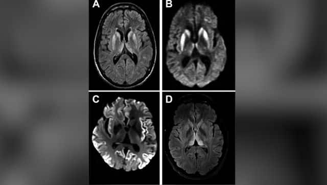 What is Creutzfeldt-Jakob disease, the rare brain condition that killed ...