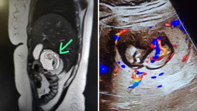 UP woman’s foetus growing in liver: What is this rare pregnancy ...