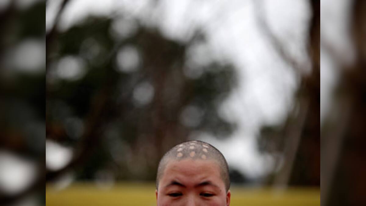 Scientists claim new baldness cure 'wakes up' hair – Firstpost