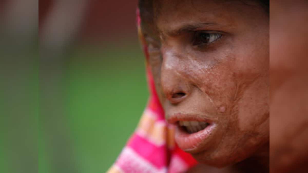 Congress goons throw acid at Maharashtra scribe and family – Firstpost
