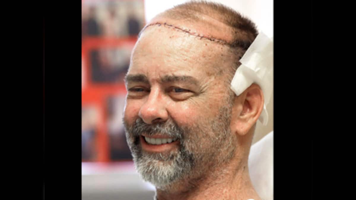 First ever skull-scalp transplant surgery performed by US doctors ...
