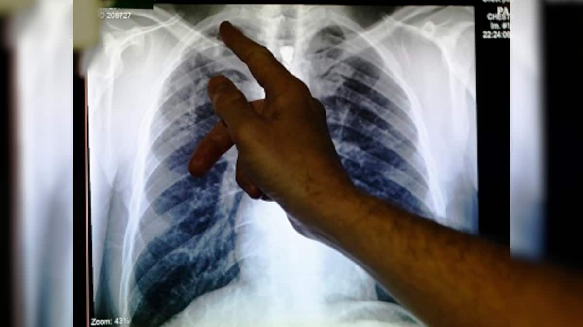 Tuberculosis deaths rise for first time in more than decade due to ...