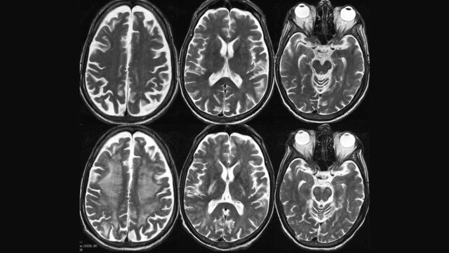 Headaches, confusion and delirium with COVID-19: How SARS-CoV-2 attacks ...