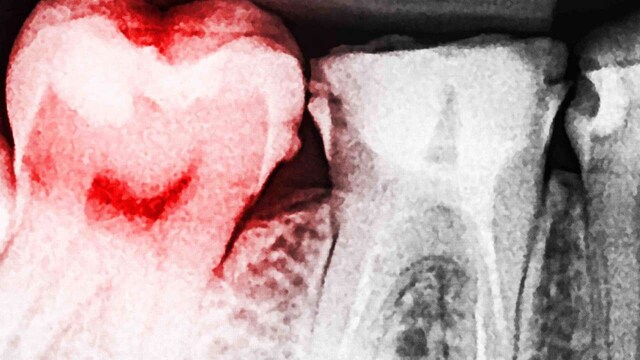 Genes, obesity and hereditary traits play a role in tooth decay, gum ...