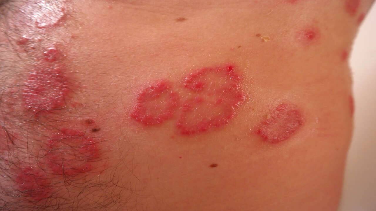 Top three myths about psoriasis, and the truth behind them-Health News ...