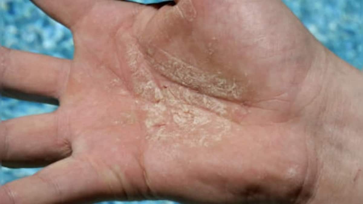 World Psoriasis Day 2021: From symptoms to risk of comorbidities, all ...