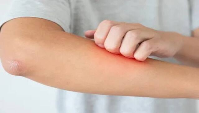 Indians with atopic dermatitis or ‘itchy rash’ need newer treatment options