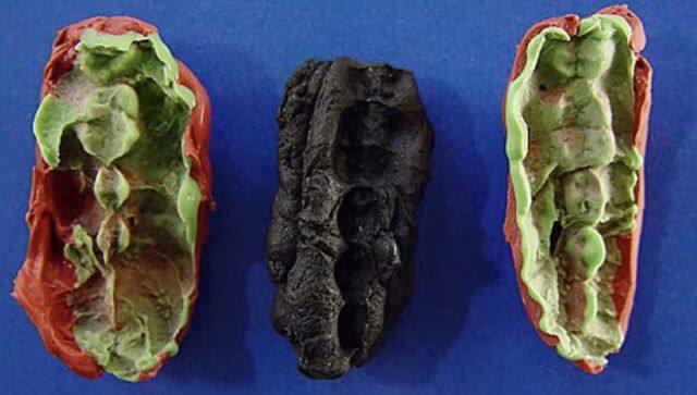 Prehistoric ‘chewing gum’ sheds light on stone age teenagers’ diet and ...